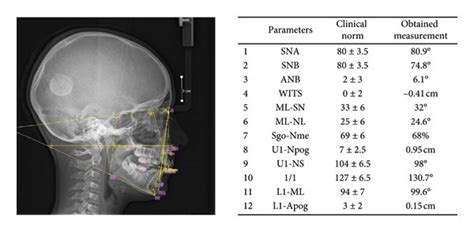 Analyzed Photographs A Lateral Cephalogram With Analysis Before