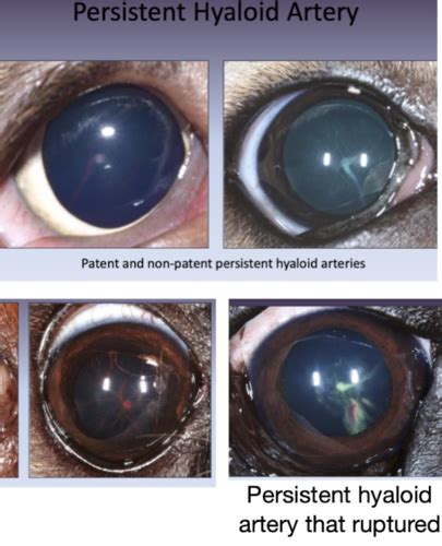 Retinal Diseases Flashcards Quizlet