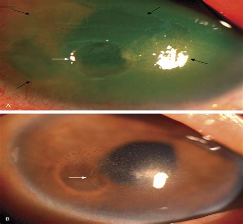 Persistent Corneal Epithelial Defect Associated With Erlotin Cornea