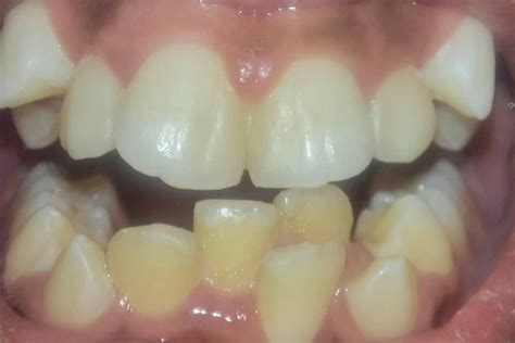 Ipr Or Extraction R Askdentists
