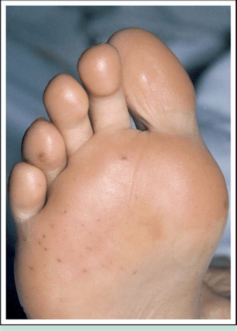 Oslers Nodes And Janeway Lesions Semantic Scholar