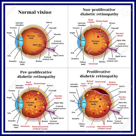 Diabetic Retinopathy Artofit