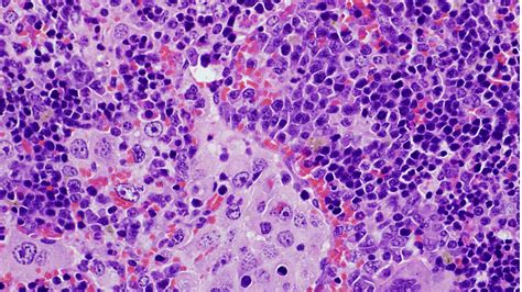 El Csic Revela Una Mutación Genética Clave En La Aparición De Linfomas Y El Cáncer De Pulmón