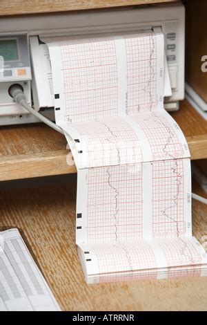 ECG EKG Graph Plot Chart Trace Showing Atrial Fibrillation AF Irregular Abnormal