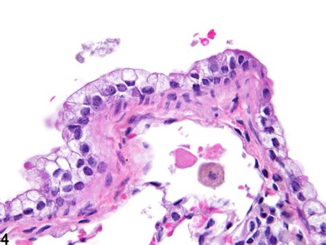 Lung Vacuolization Cytoplasmic Nonneoplastic Lesion Atlas