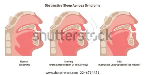 Obstructive Sleep Apnoea Over 8 Royalty Free Licensable Stock