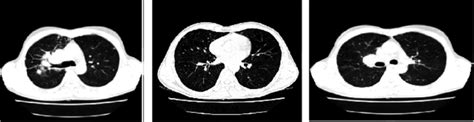 Lung Cancer Sample 3 Pre‐process Image Download Scientific Diagram