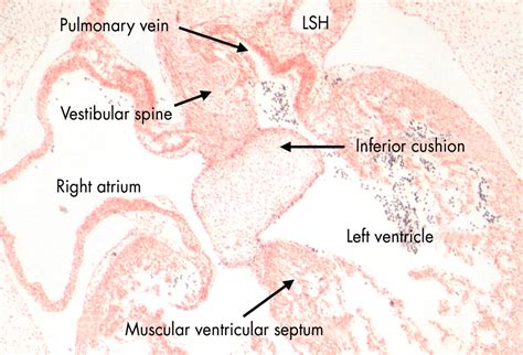 Development Of The Heart Septation Of The Atriums And Ventricles Heart