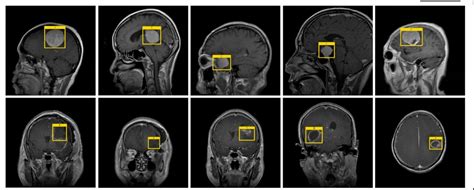 brain tumor localization and detection from mri images using yolov8