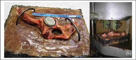 Figure 1 From Measurement Of Safe Acetabular Medial Wall Defect Size In