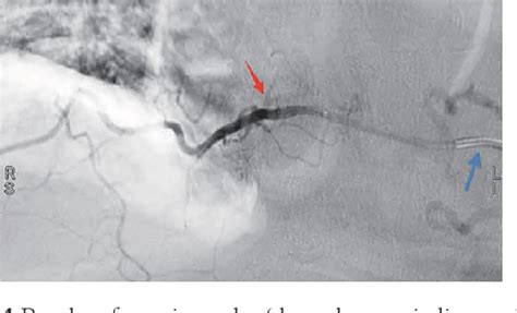 Figure 1 From Embolization Of The Esophageal Branch Of Intercostal