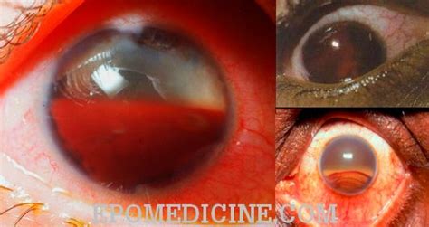 Ophthalmology Spot Diagnosis Hyphema Epomedicine