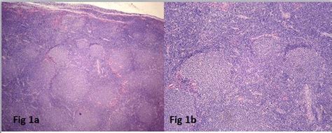 A Low Power View Of Lymph Node Showing Follicular Architecture H And E