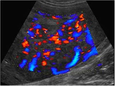 Abdomen And Retroperitoneum 1 1 Liver Case 1 1 1 Focal Nodular