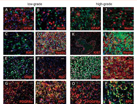 Figure 2 From Tumor Progression And Oncogene Addiction In A Pdgf B