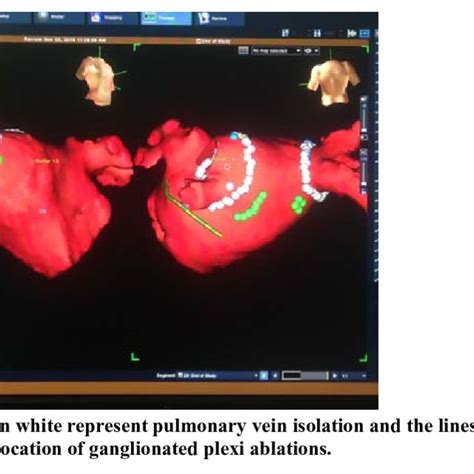Spontaneous Termination Of Atrial Fibrillation After Ablation Of All Download Scientific