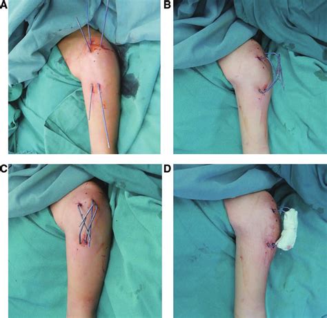 A The K Wires Are Introduced Into The Distal Fragment B The Wire Download Scientific