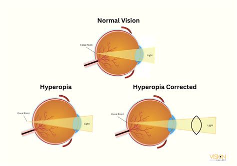 Myopia Vs Hyperopia Key Differences Symptoms And Treatments