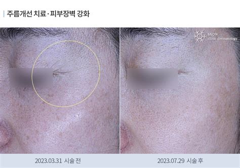 모공 ·주름 대전 둔산동 스노우의원
