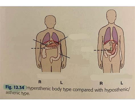 Hypersthenic Vs Hyposthenic Body Type Quiz