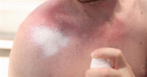 Man Applying Moisturizing Cream To Red Irritated Skin Closeup 4k Movie