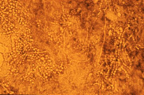 Tinea Cruris Microscope