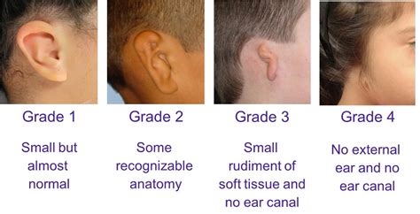 Microtia Ear Surgery And Bone Anchored Hearing Devices Sheryl Lewin Bone Conduction And Middle Ear