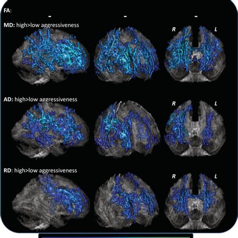 Tract‐based Spatial Statistics Tbss Subgroup Analyses Of Patients