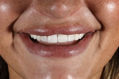 Correcting Misalignment And Edges With Direct Composite Edge Bonding Maison Dental