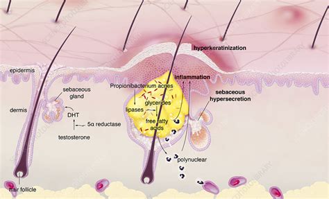 Hyperkeratinization Acne