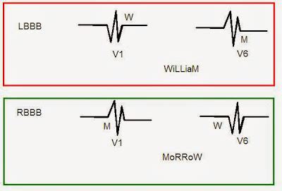 Left Vs Right Bundle Branch Block