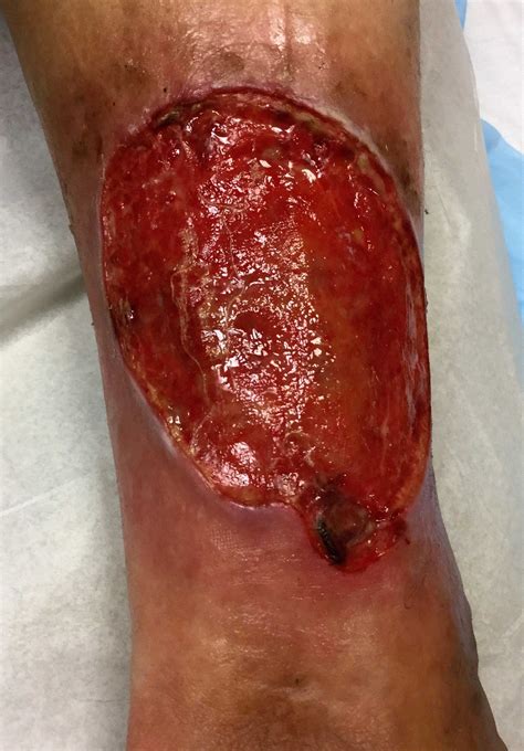 Pathology Outlines Pyoderma Gangrenosum