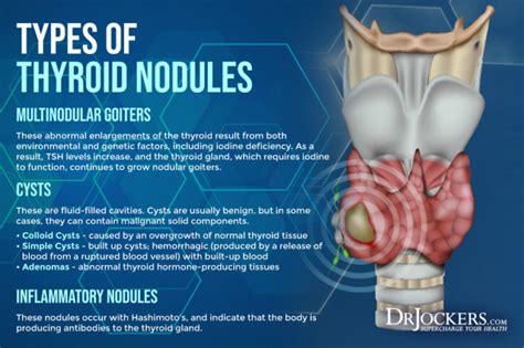 What Are Thyroid Nodules Thyroid Nodule Causes And Symptoms Hot Sex Picture