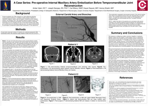 Pdf A Case Series Pre Operative Internal Maxillary Artery Embolization Before