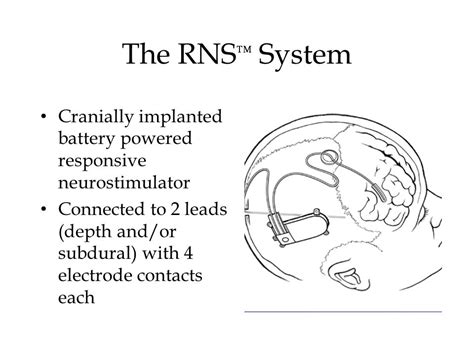 Responsive Neurostimulation Rns For The Treatment Of Epilepsy Ppt Download