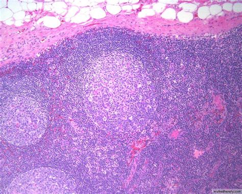 Pathology Of Lymph Node Pptx D Hameed Muhadharaty