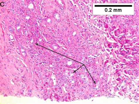 Cholangiocarcinoma Libre Pathology