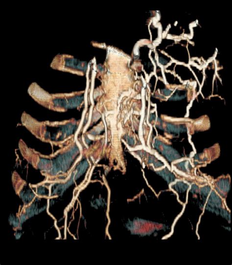 Figure 7 From Amazing Anatomy Roadmaps Of Venous Collateral