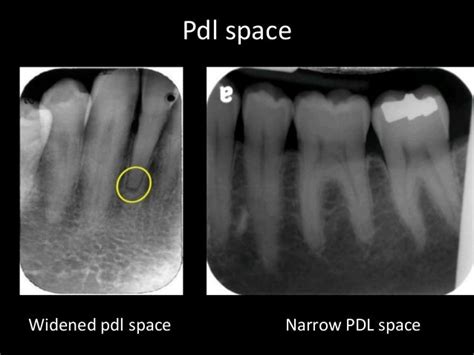 Radiographoftheday Widened Periodontal Ligament Space Intra Oral