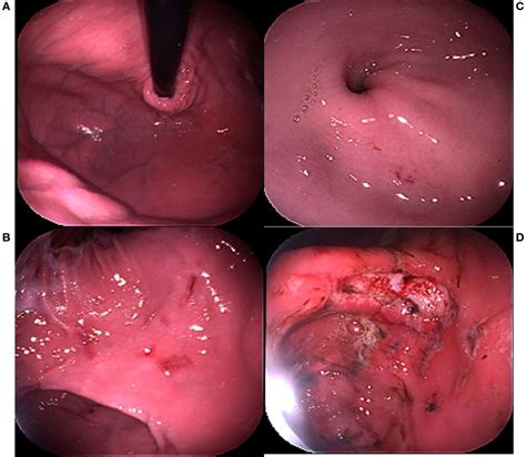Endoscopy Severity Score Ess Guide A Ess 0 B Ess 1 C