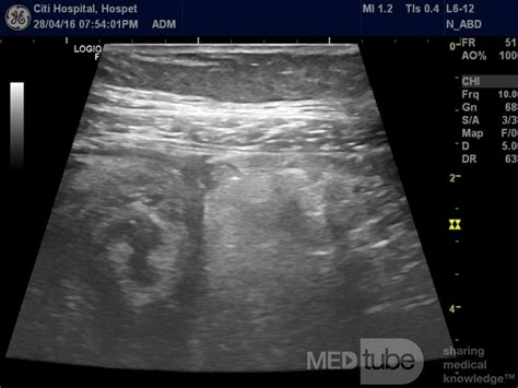 Appendicular Abscess Usg 2 • Image •