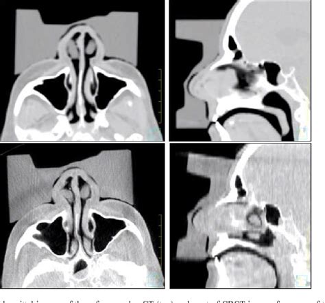 figure 1 from image‐guided bolus electron conformal therapy a case