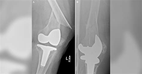 82 Year Old Woman With A Periprosthetic Distal Femur Fracture