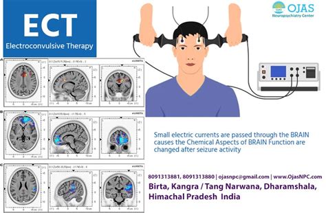 Electroconvulsive Therapy Diagram