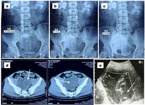 Figure 1 From Primary Hydatid Cyst Of The Urinary Bladder With Associated Eosinophilic Cystitis