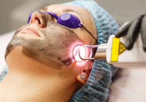 Laser Stretch Mark Treatment Lygos Clinic