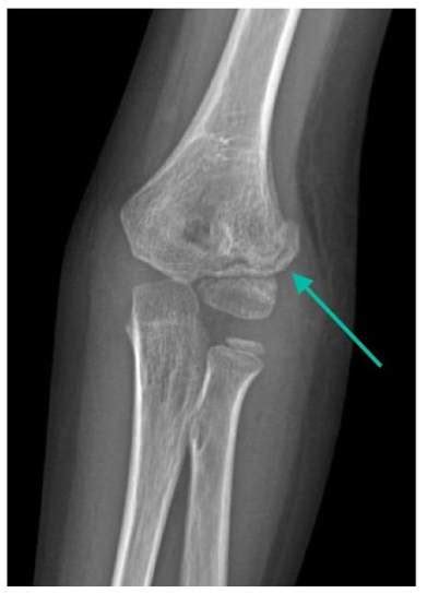 Aliem Orthopedic Splinter Series Fracture After A Fall From A Bunk Bed