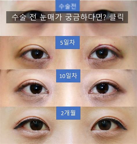 다양한 눈매의 매몰법붓기 케이스 눈매교정 눈성형의 모든것 비씨아이 성형외과