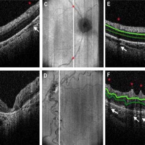 Algorithm For The Diagnosis Of Infantile Nystagmus Syndrome On The