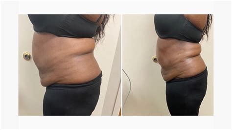What To Do After Laser Lipo And Cavitation